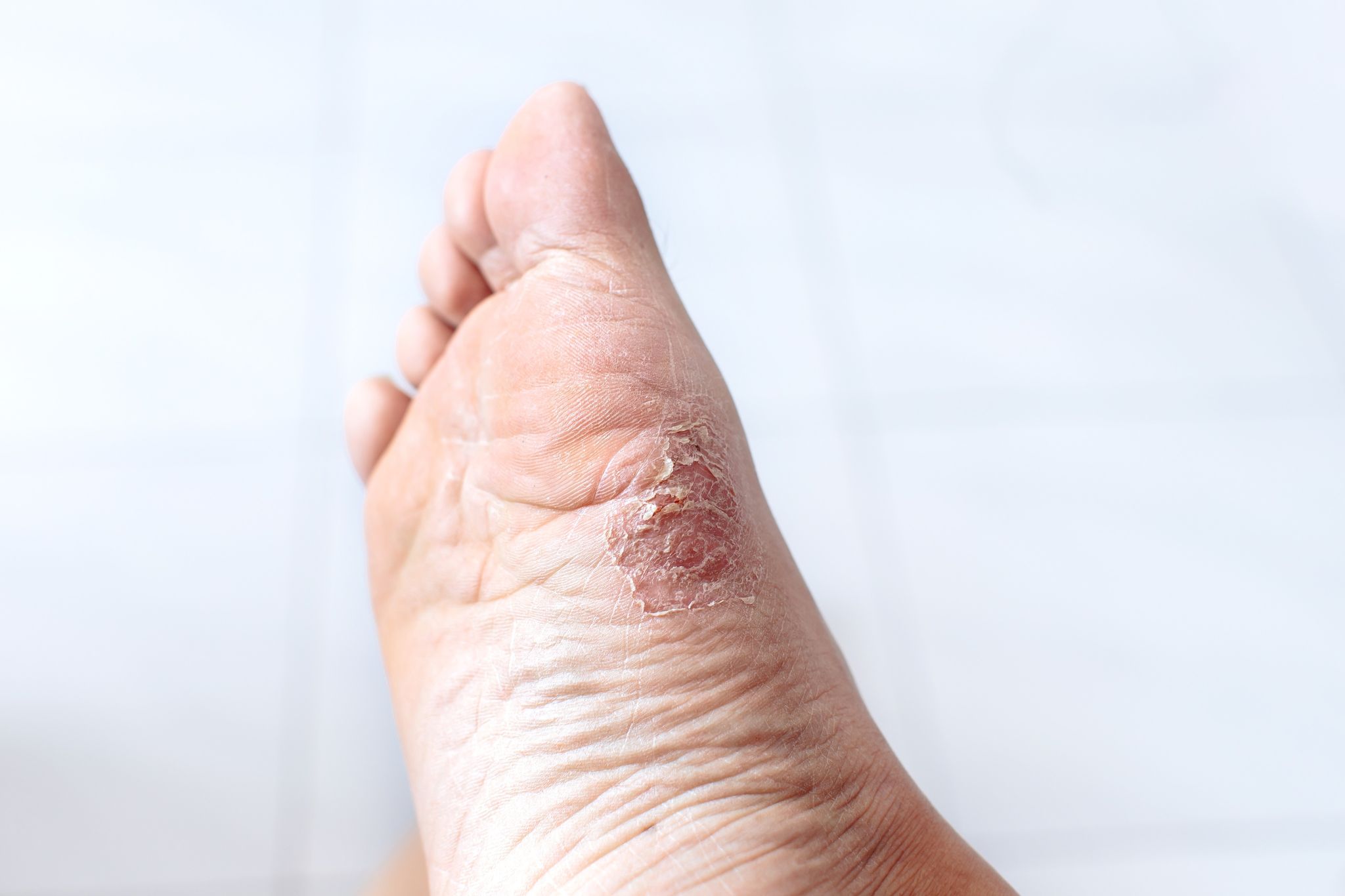 Tips to Prevent Athlete's Foot Fungus - Feet Relief