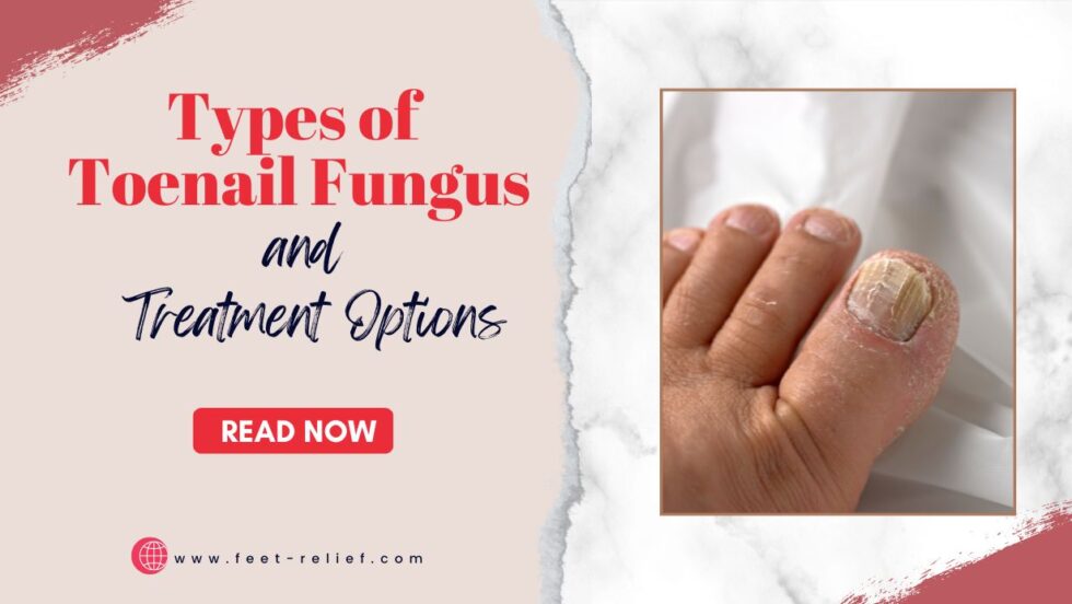 Types of Toenail Fungus and Treatment Options - Feet Relief