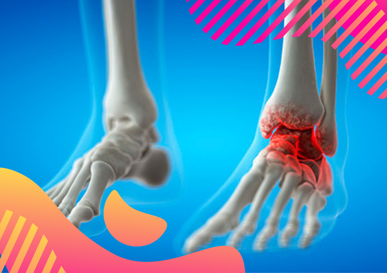Foot and Ankle Arthritis Treatment - Feet Relief