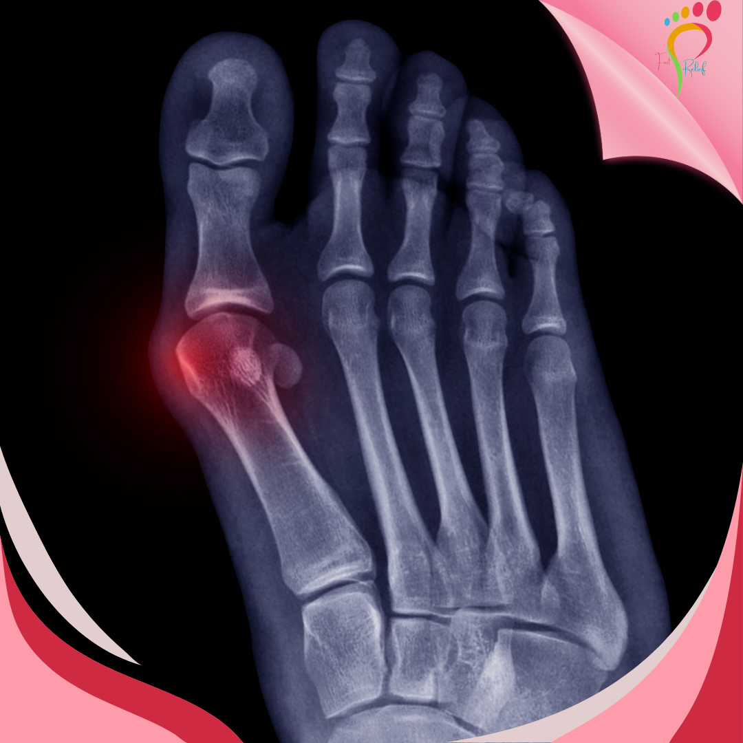 Treating Bunions: Your Essential Guide - Feet Relief