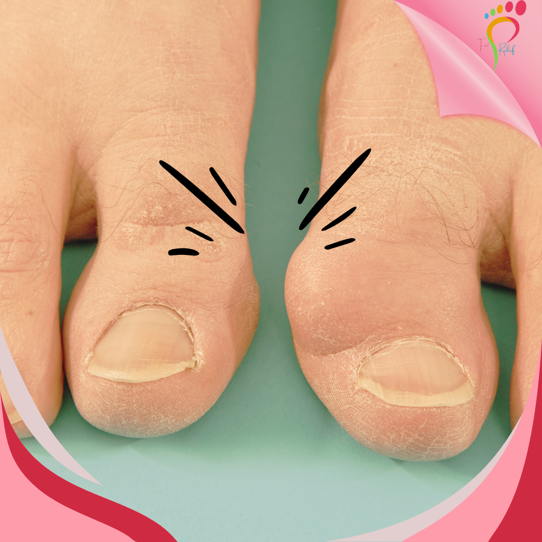 Treating Bunions: Your Essential Guide - Feet Relief